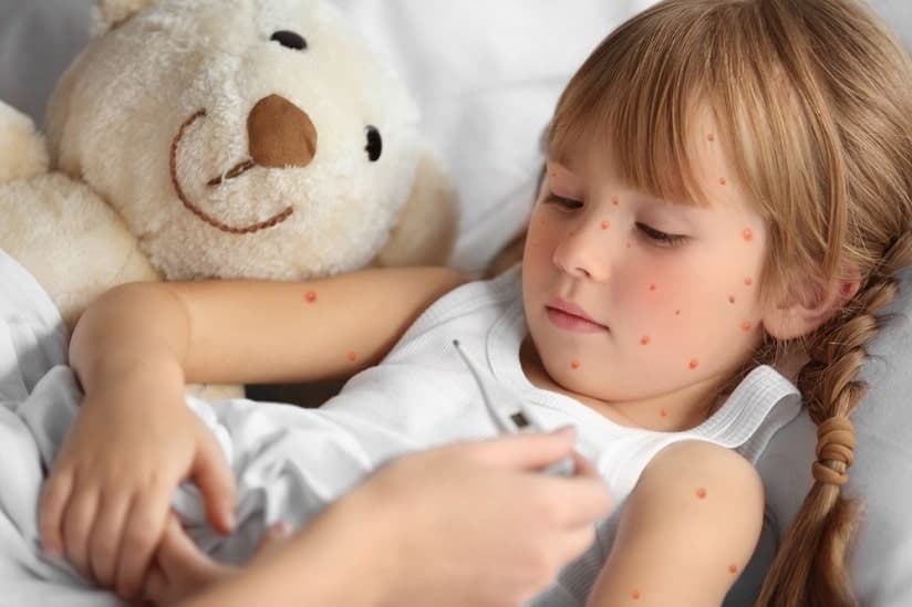 Foods to Eat and Avoid When You Have Chickenpox : Okadoc Blog